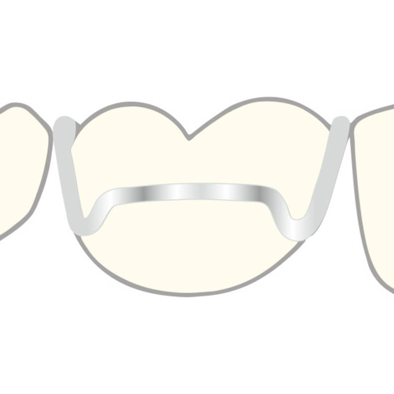 Adams Clasps SCHEU-DENTAL
